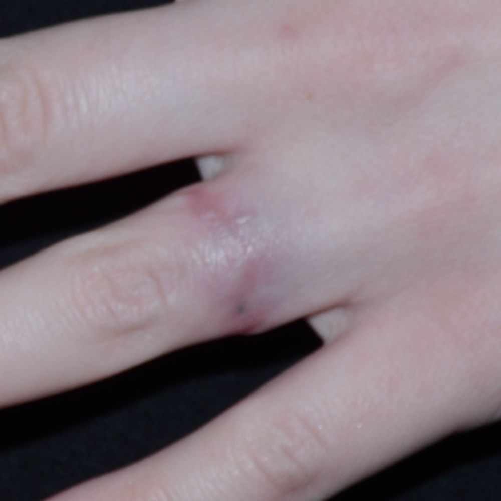 Tattoo Excision by James M. Nachbar, MD, FACS, Scottsdale, Arizona ...